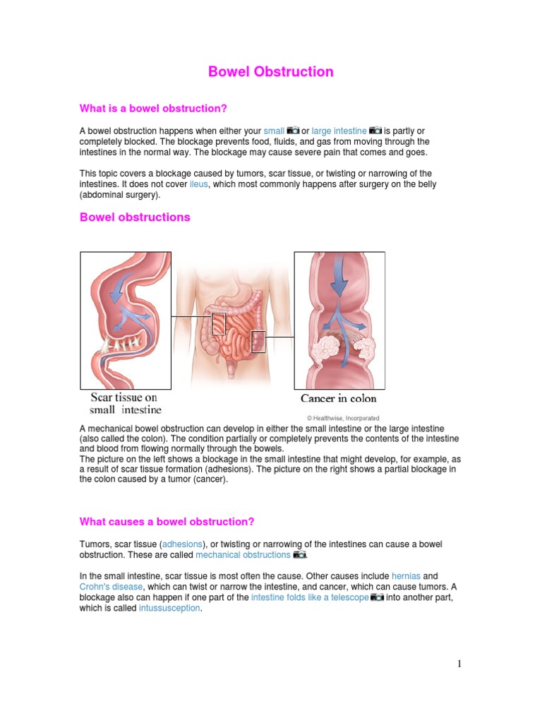 Bowel Obstruction | PDF | Bloating | Gastrointestinal Tract