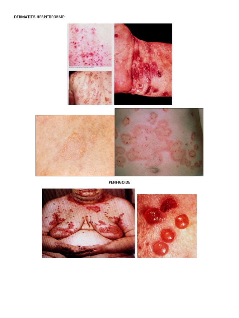 Enfermedades Cutáneas: Tuberculosis y Verrugas | PDF | Tuberculosis ...