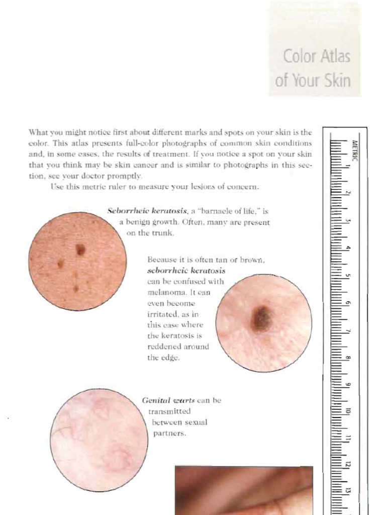 Color Atlas of Your Skin | PDF | Cancer | Neoplasms