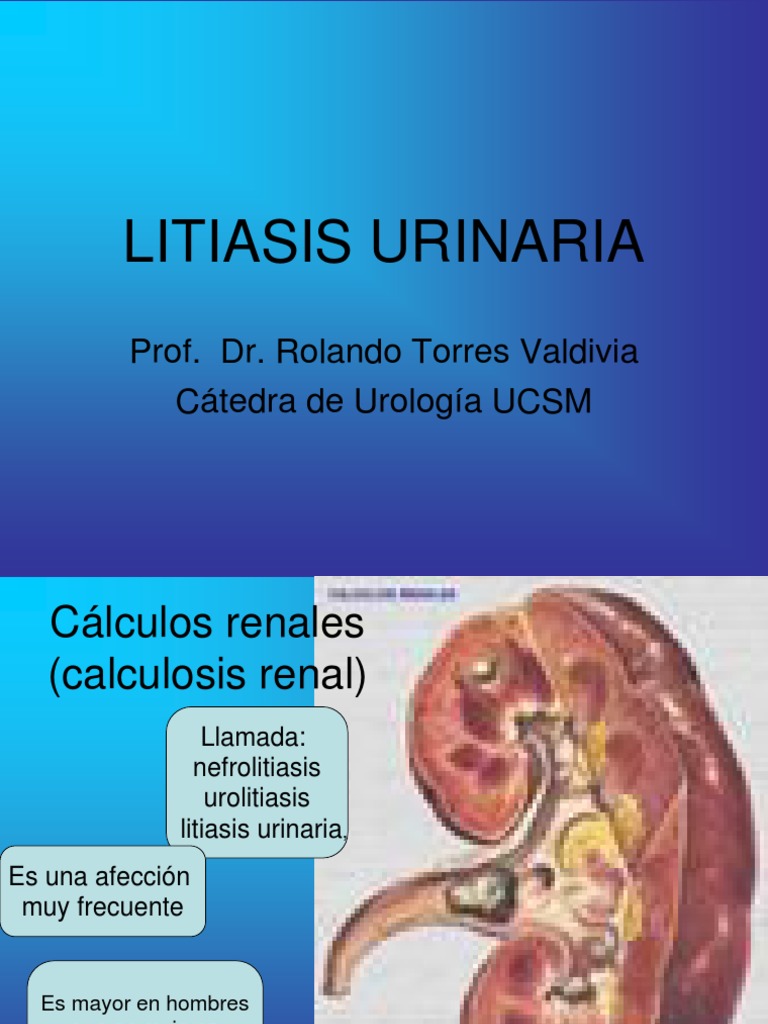 Microlitiasis Renal y Litiasis Calicial | PDF | Órgano (anatomía) | Riñón