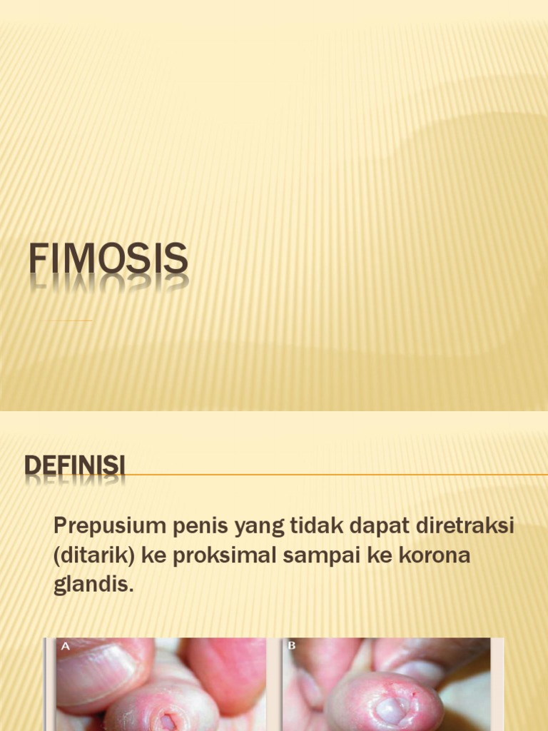 Fimosis pada Anak: Definisi dan Penanganan | PDF