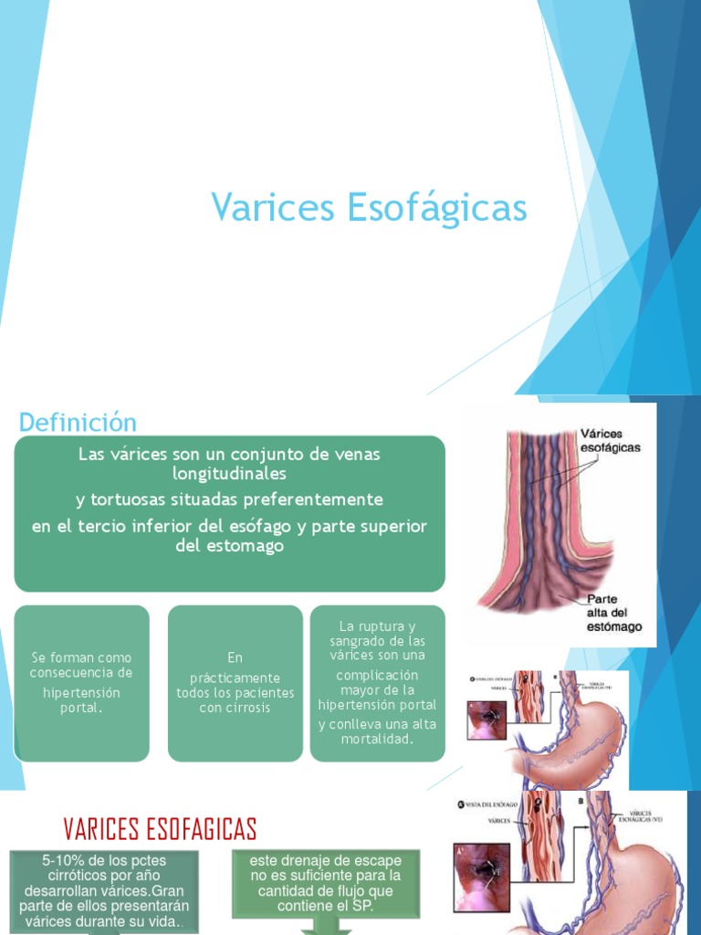 Varices Esofágicas | PDF | Enfermedades vasculares | Medicina CLINICA