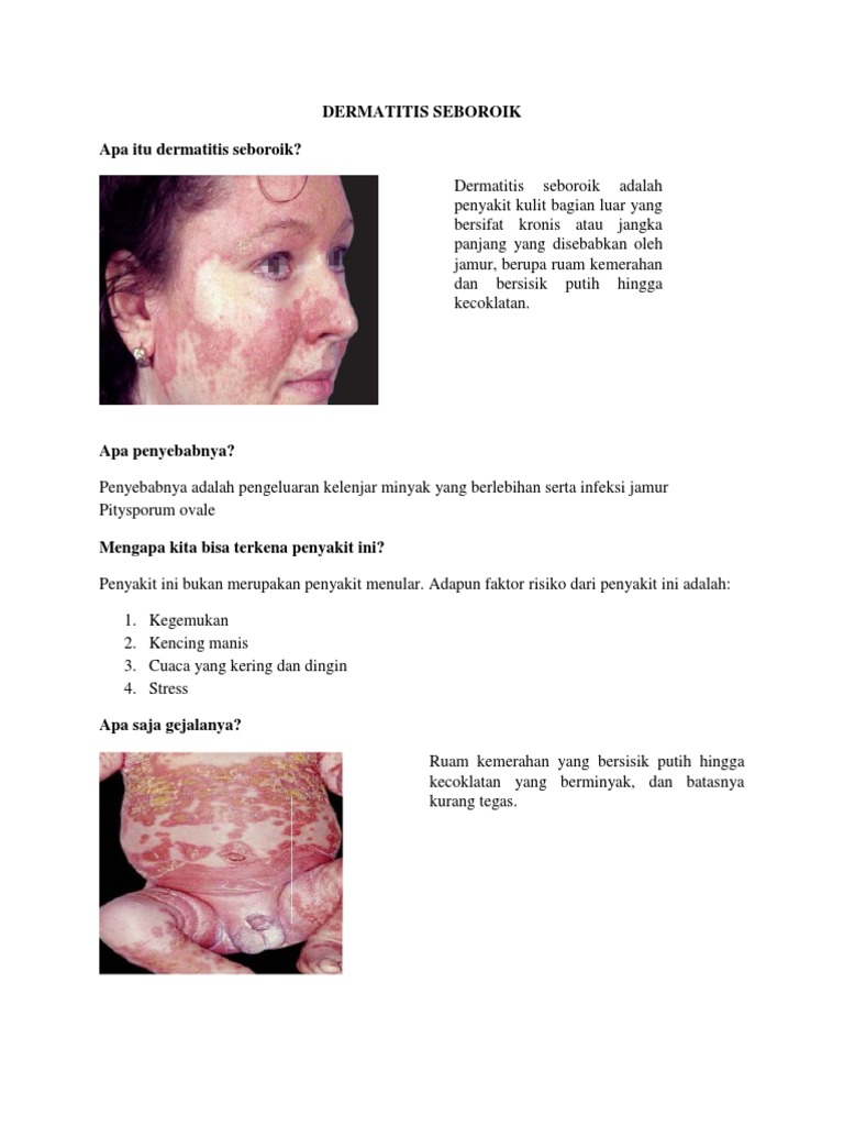 Apa Itu Dermatitis Seboroik | PDF