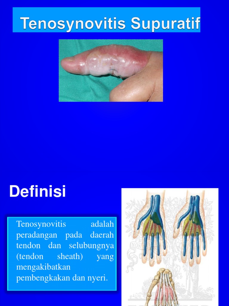 Tenosynovitis Supuratif | PDF