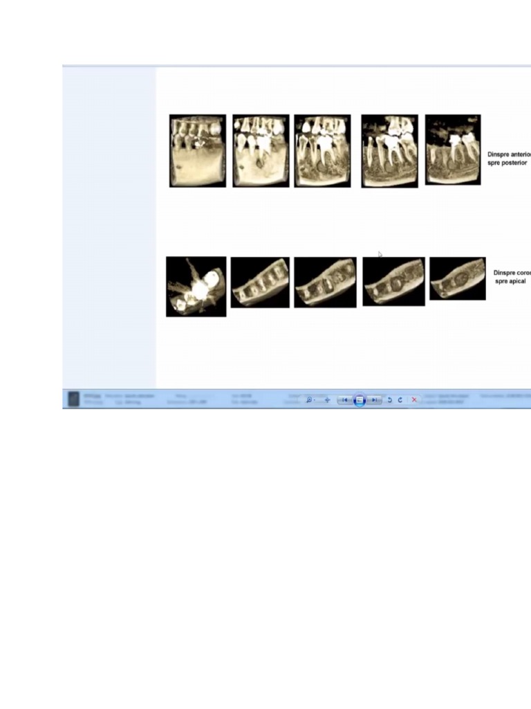 Chist Mandibular | PDF