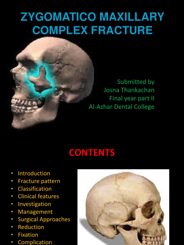 Zygomatico Maxillary Complex Fracture: Submitted by Josna Thankachan ...
