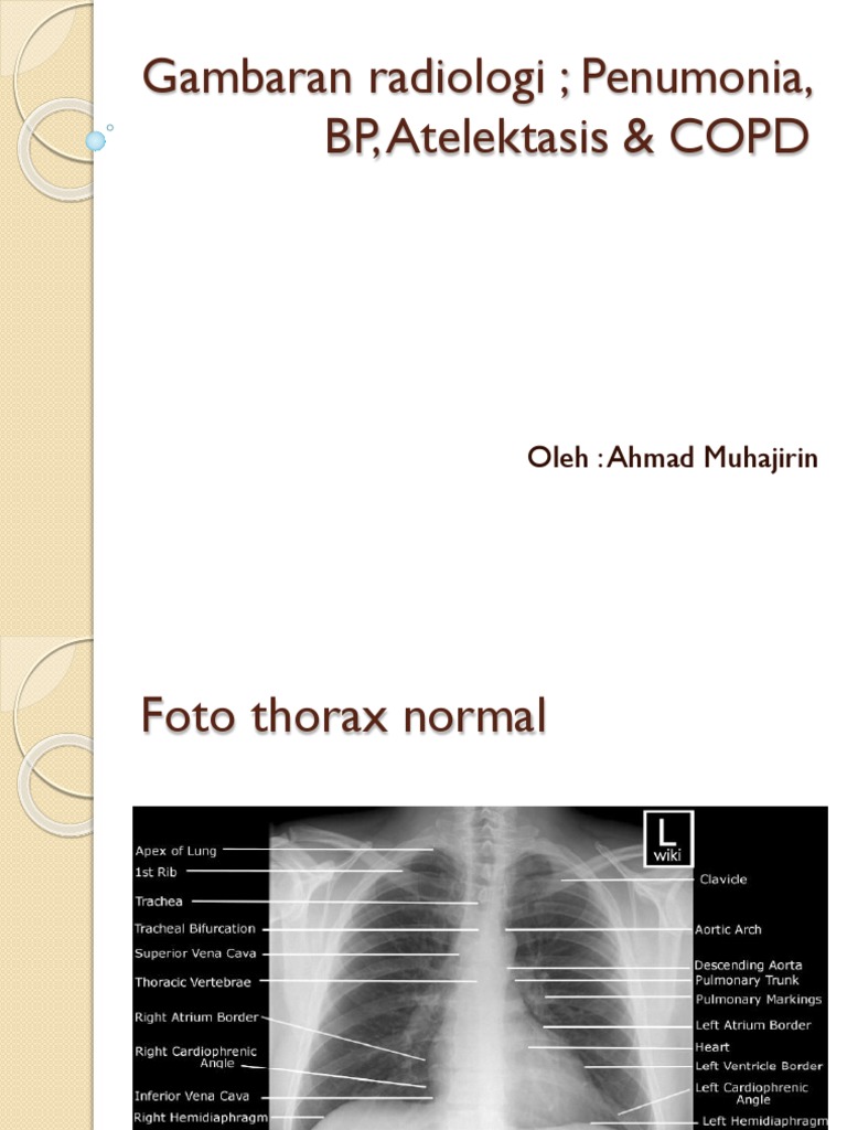 Gambaran Radiologi Thorax | PDF | Lung | Chronic Obstructive Pulmonary ...