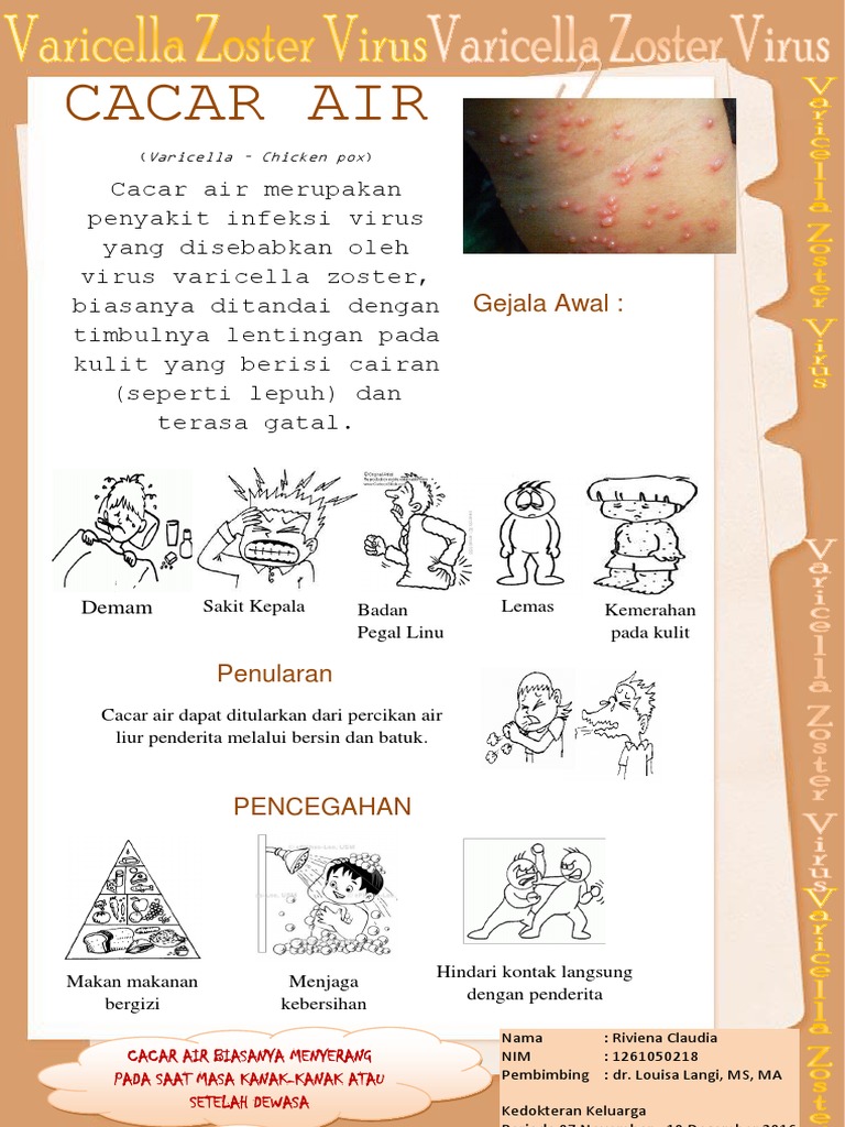 POSTER Tentang Cacar Air Chicken Pox | PDF