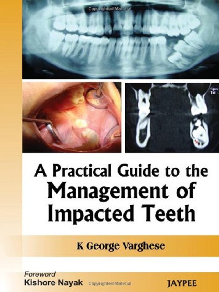A Practical Guide To The Management of Impacted Teeth PDF | PDF | Tooth ...