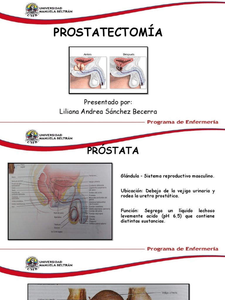 Prostatectomía | PDF | Cancer de prostata | Urología