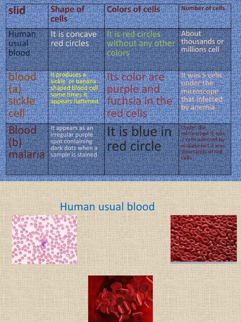 Blood (A) Sickle Cell: Its Color Are Purple and Fuchsia in The Red ...