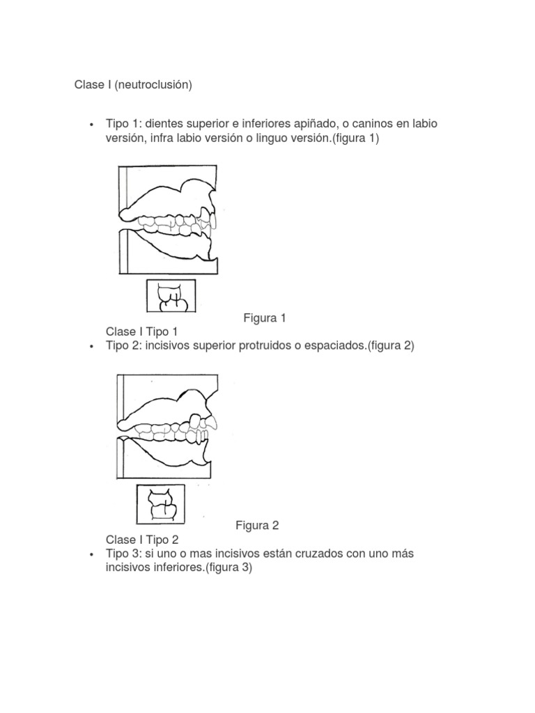 Clasificacion de Angle y Sus Modificaciones | PDF