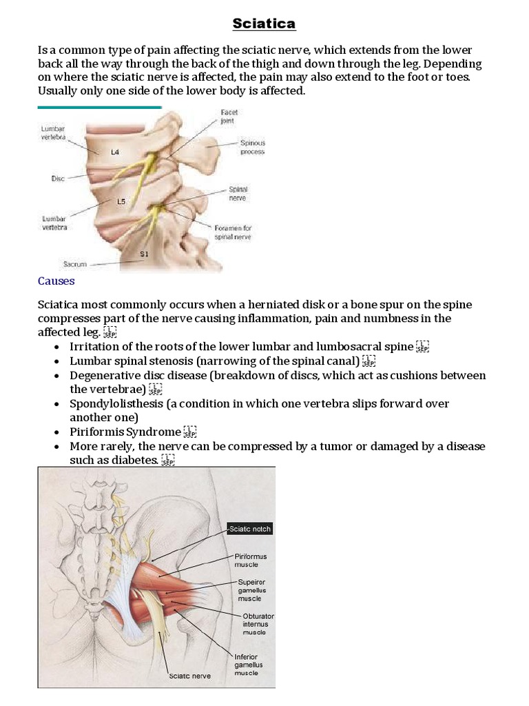 Understanding Sciatica: Causes, Symptoms, Treatments and Exercises for ...