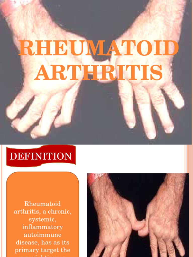 Understanding Rheumatoid Arthritis: Causes, Symptoms, and Treatment ...