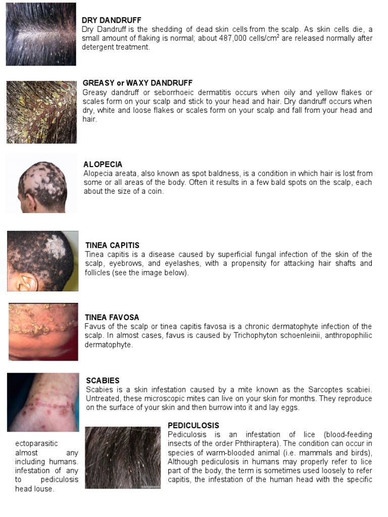 Dry Dandruff With Meaning and Picture | Hair Loss | Integumentary System