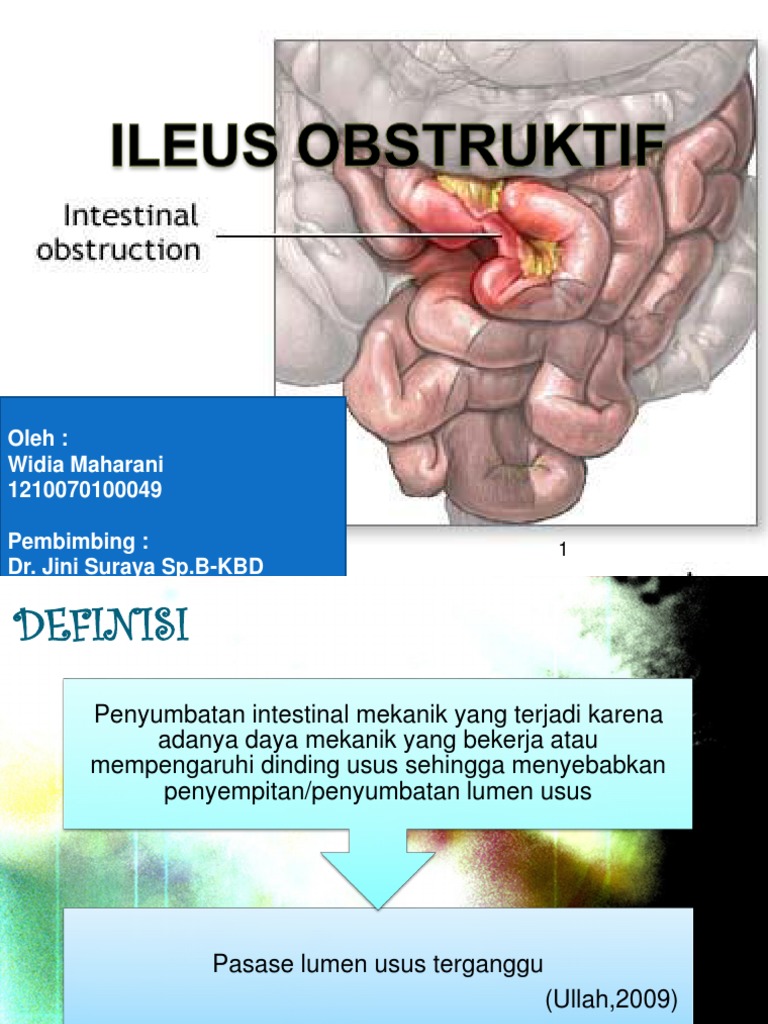 AWID PPT Ileus Obstruksi | PDF