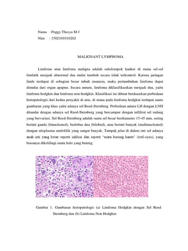 Diagnosis dan Prognosis Limfoma Maligna | PDF