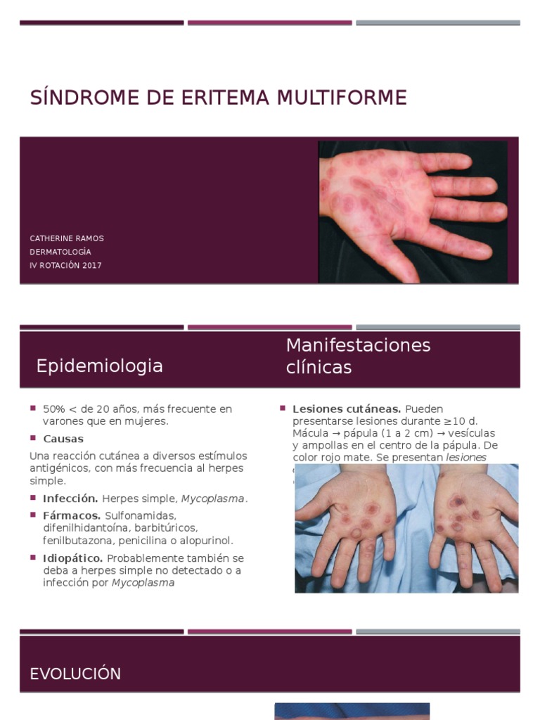 Síndrome de Eritema Multiforme | PDF | Medicina CLINICA | Especialidades Medicas