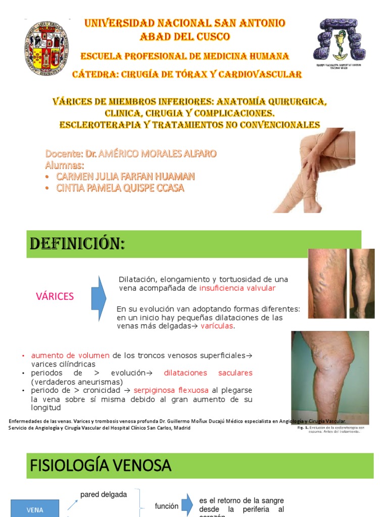 Comprensión integral de las varices: definición, anatomía ...