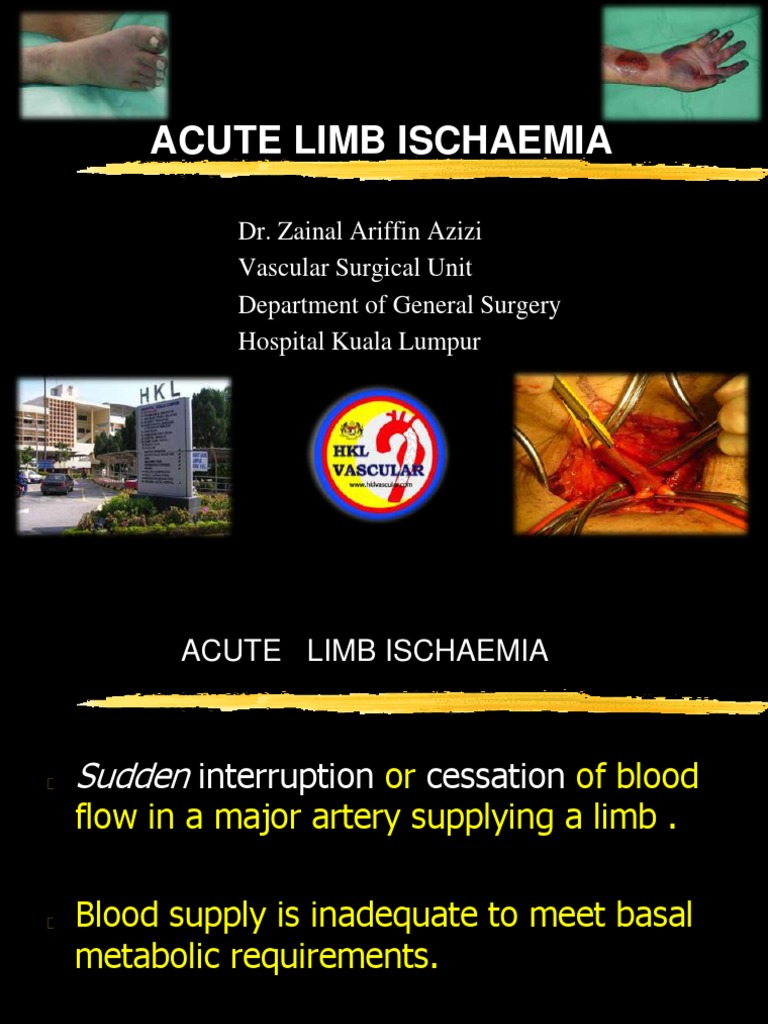 Acute Limb Ischaemia | Ischemia | Thrombosis