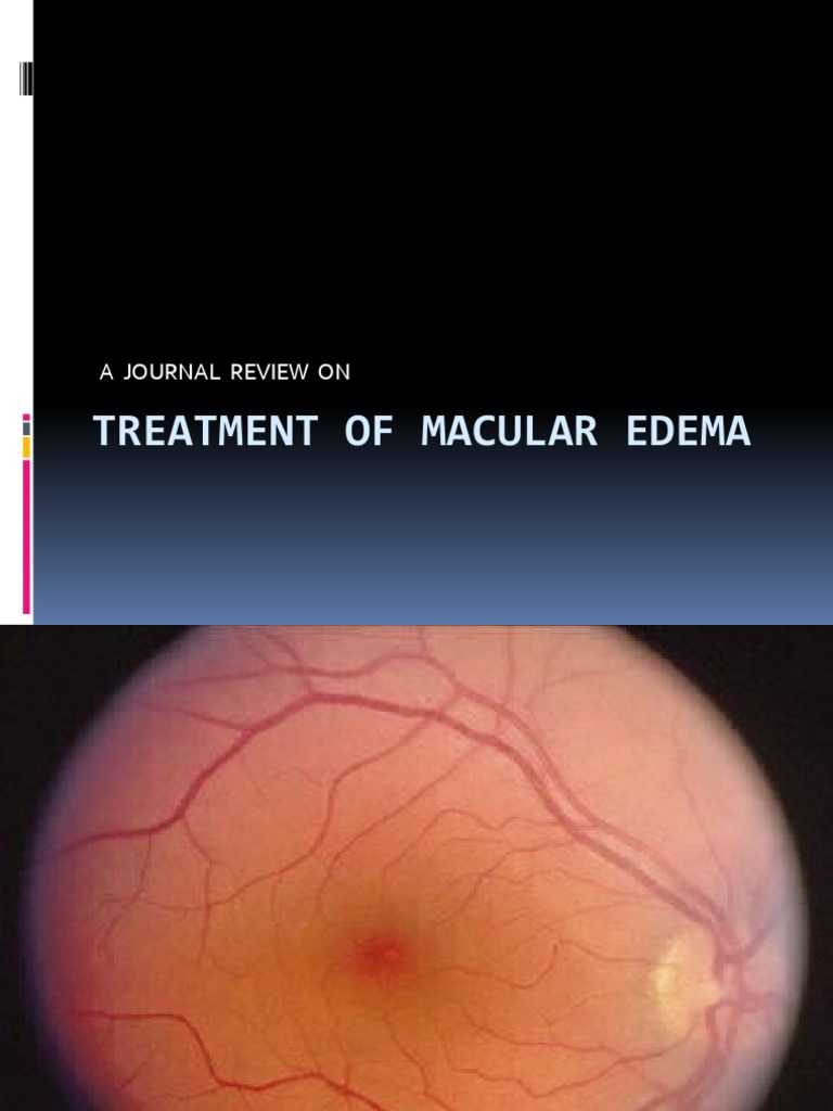 Treatment of Macular Edema | PDF | Retina | Vision