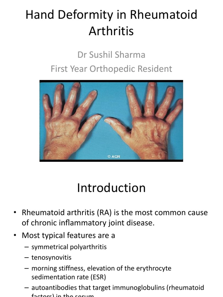 Hand Deformity in Rheumatoid Arthritis: DR Sushil Sharma First Year ...