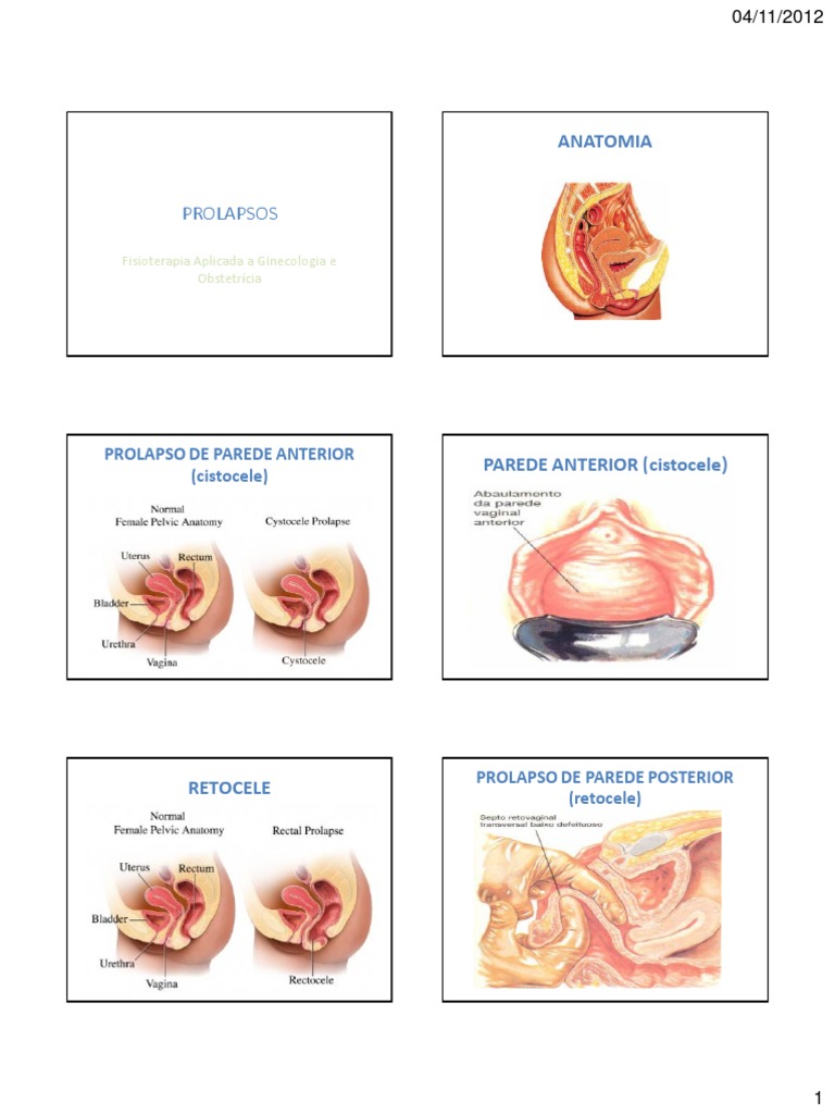 Prolapsos PDF | PDF | Saúde Sexual | Saúde feminina