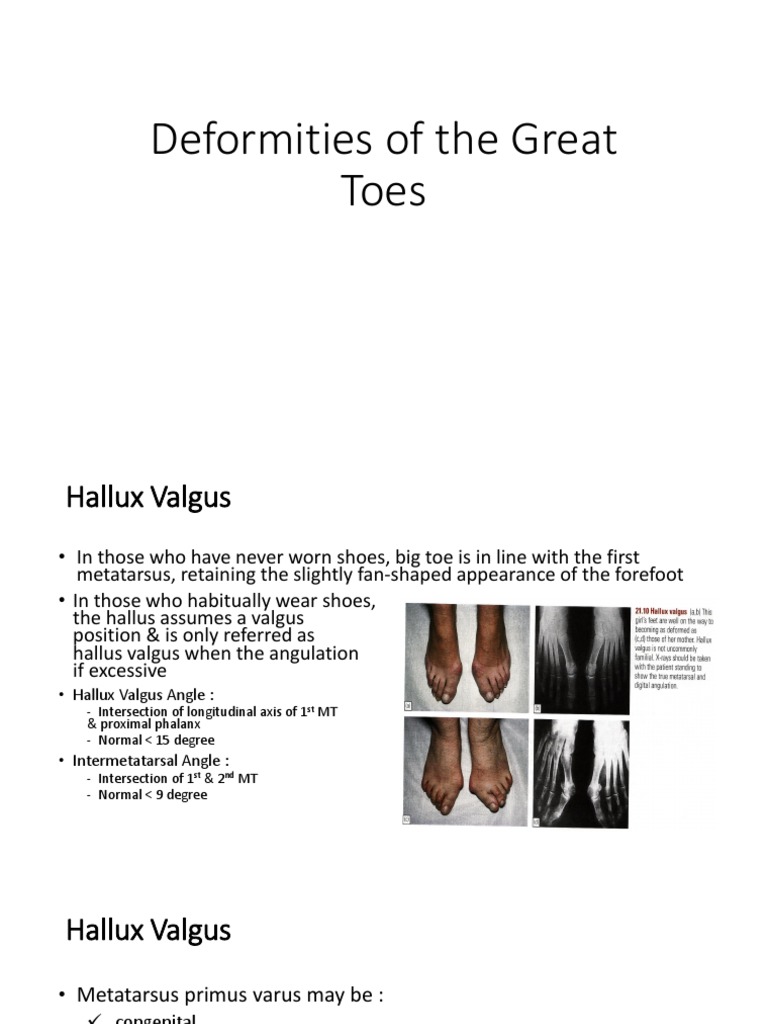 Deformities of Greater and Lesser Toes | Toe | Anatomical Terms Of Motion