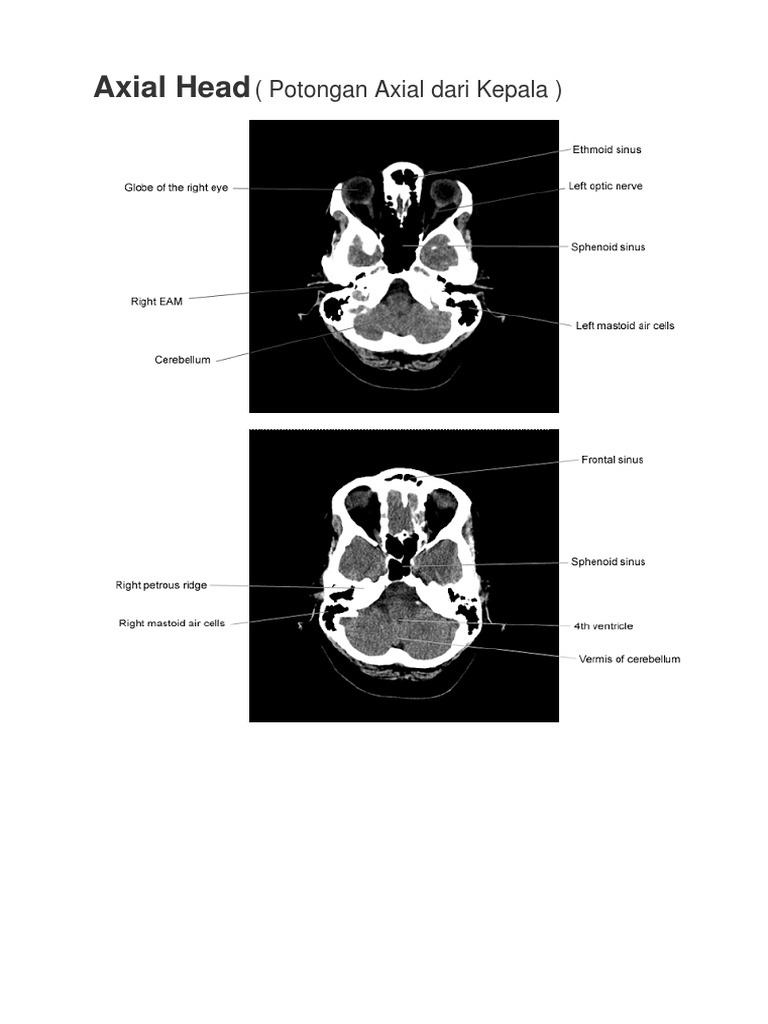 Axial Head Anatomi Radiologi | PDF