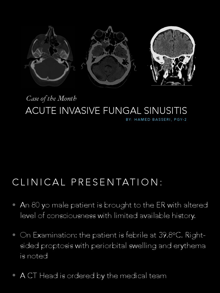 Acute Invasive Fungal Sinusitis: Case of The Month | PDF | Clinical ...