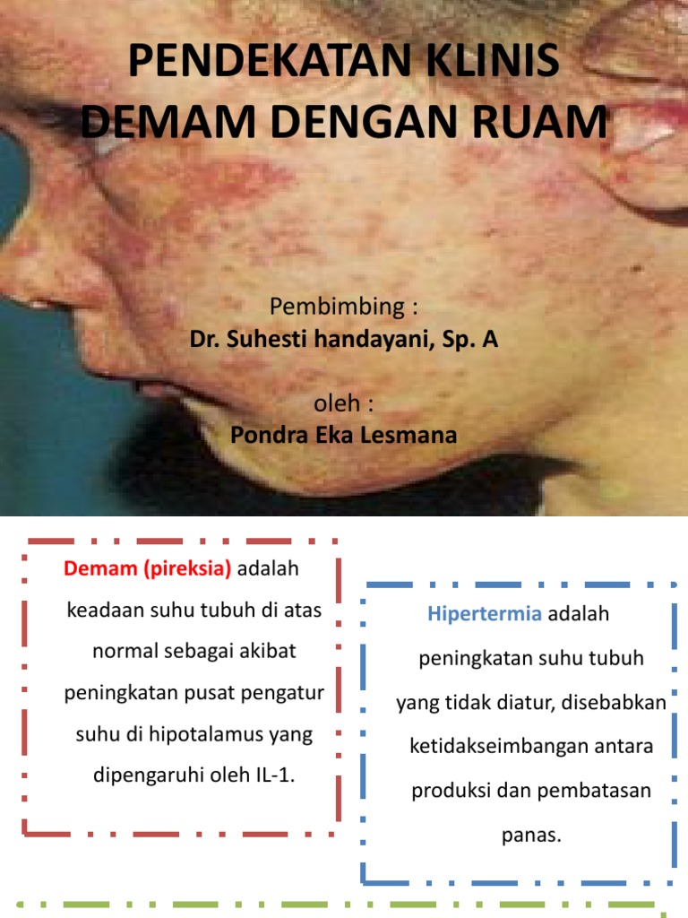 Referat Demam Dengan Ruam Deef | PDF