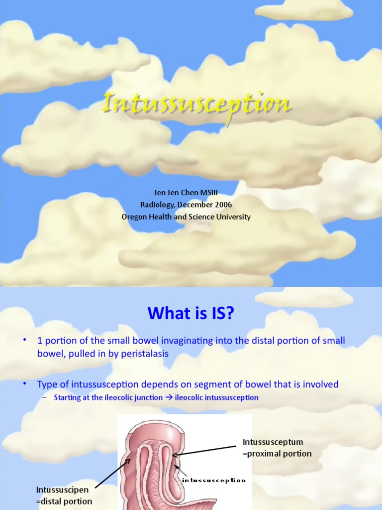 Intussusception | PDF | Medicine | Gastroenterology
