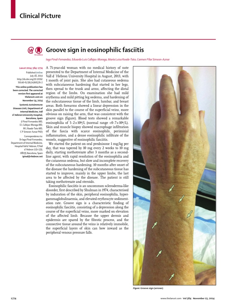 Clinical Picture: Groove Sign in Eosinophilic Fasciitis | PDF ...