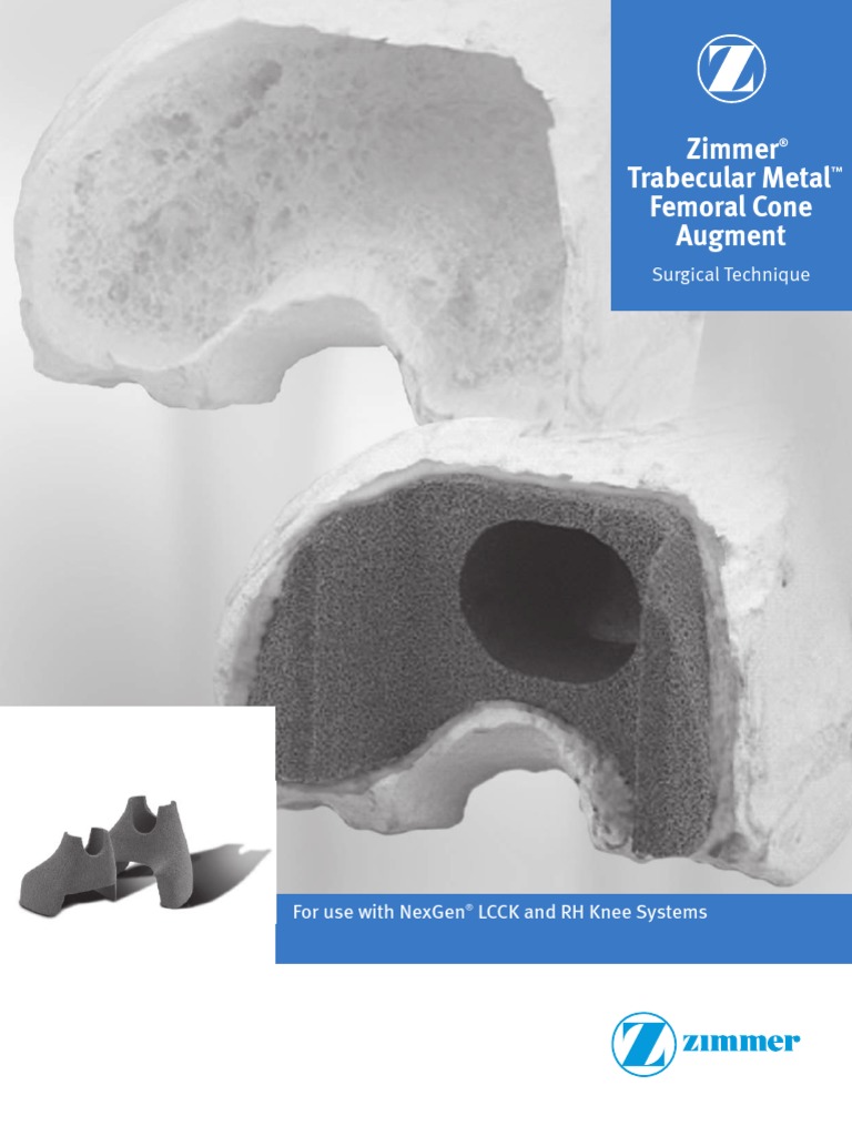 Zimmer Trabecular Metal Femoral Cone Augment Surgical Technique | PDF ...