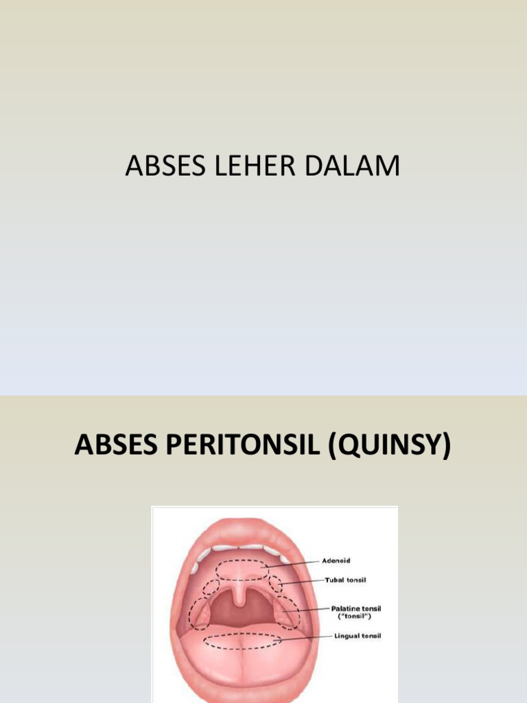 ABSES LEHER DALAM Paritonsil (Quinsy) Dan Submandibula | PDF