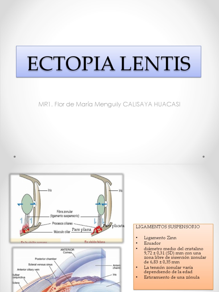 Ectopia Lentis | PDF | Ojo humano | Glaucoma