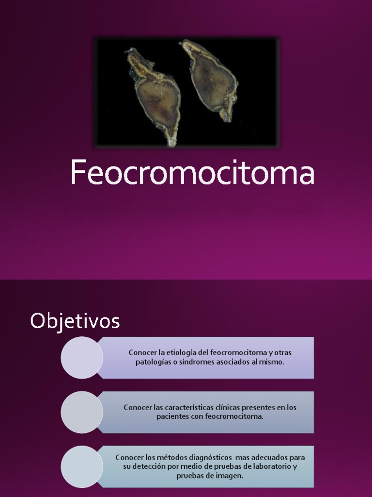 Feocromocitoma: Diagnóstico y Tratamiento | PDF | Arritmia cardiaca ...