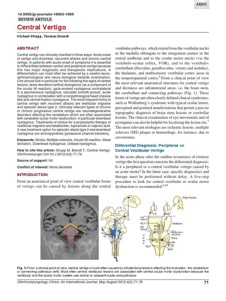 Central Vertigo PDF | PDF | Vertigo | Vestibular System