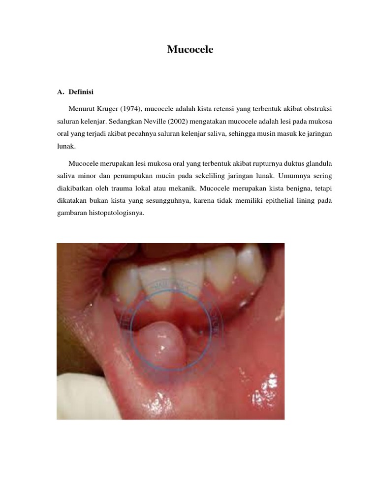 Makalah Mucocele Dan Ranula