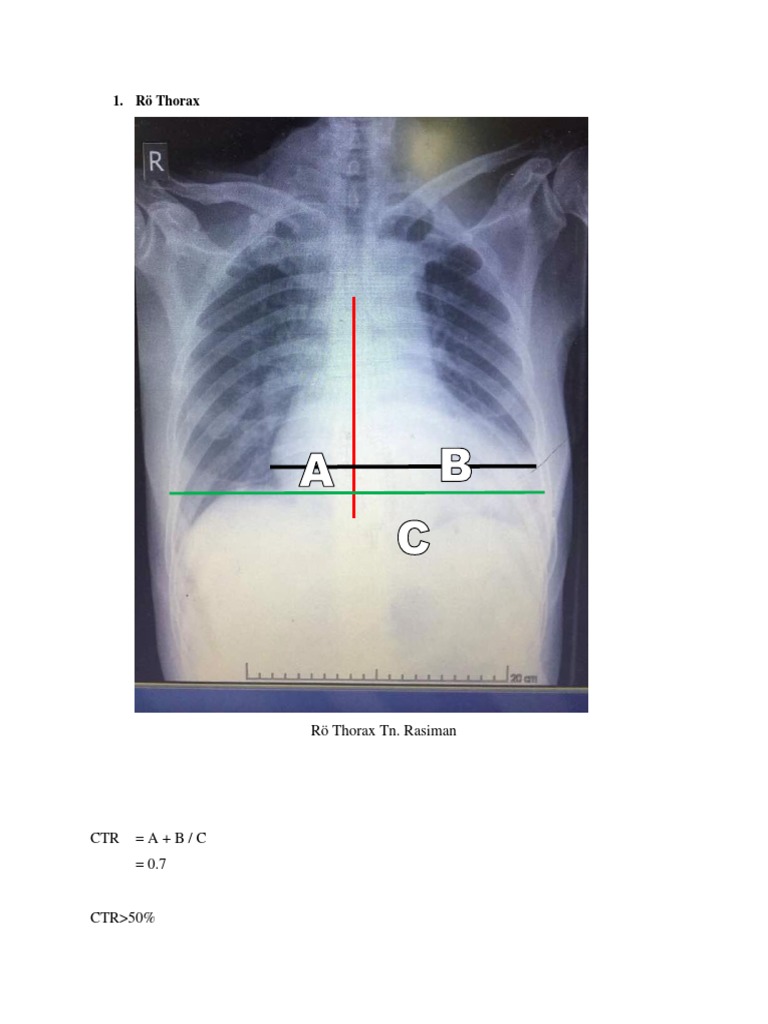 Rö Thorax | PDF