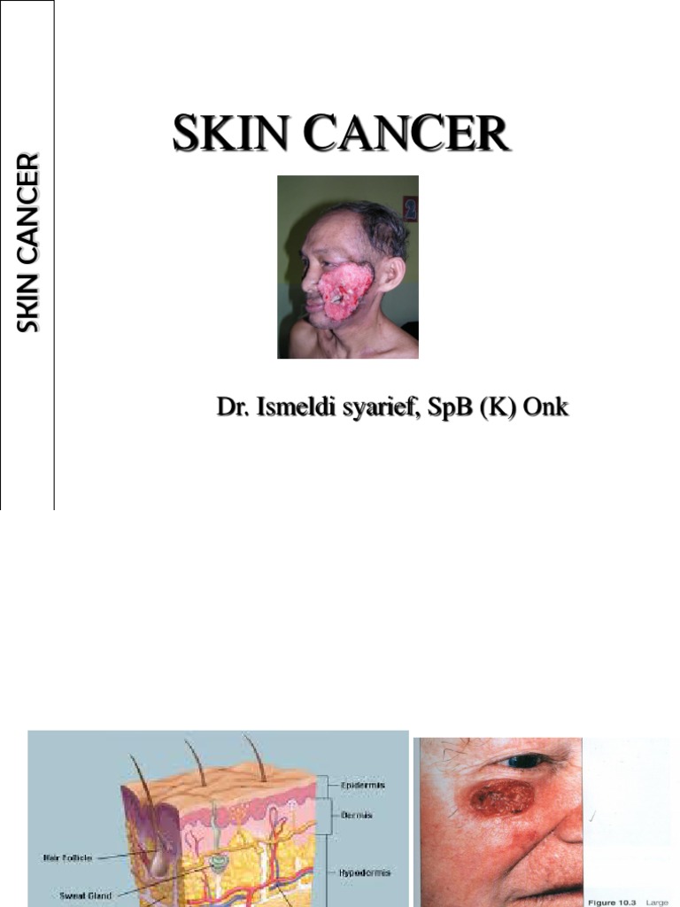 Kuliah BRH Kanker Kulit | PDF | Melanoma | Skin Cancer