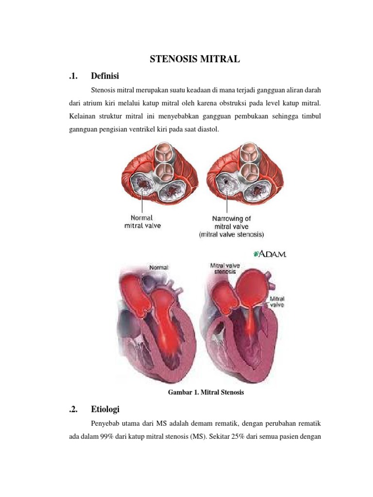MItral Stenosis | PDF