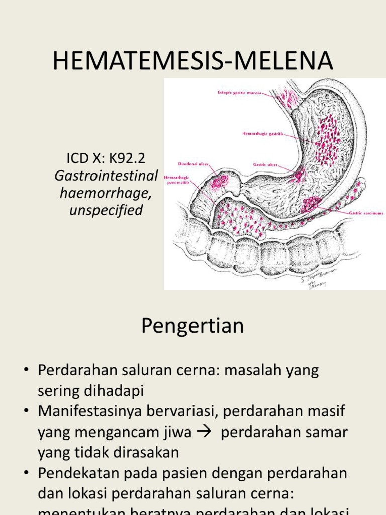 Hematemesis Melena | PDF