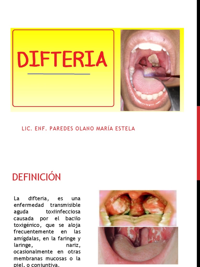 Definición y Tratamiento de Difteria | PDF | Especialidades Medicas ...