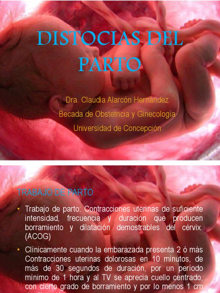 Distocias Del Parto PDF | PDF | Parto | El embarazo