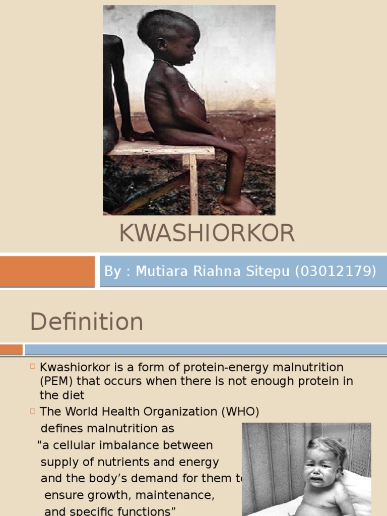 Kwashiorkor 2 Pdf Malnutrition Health Sciences