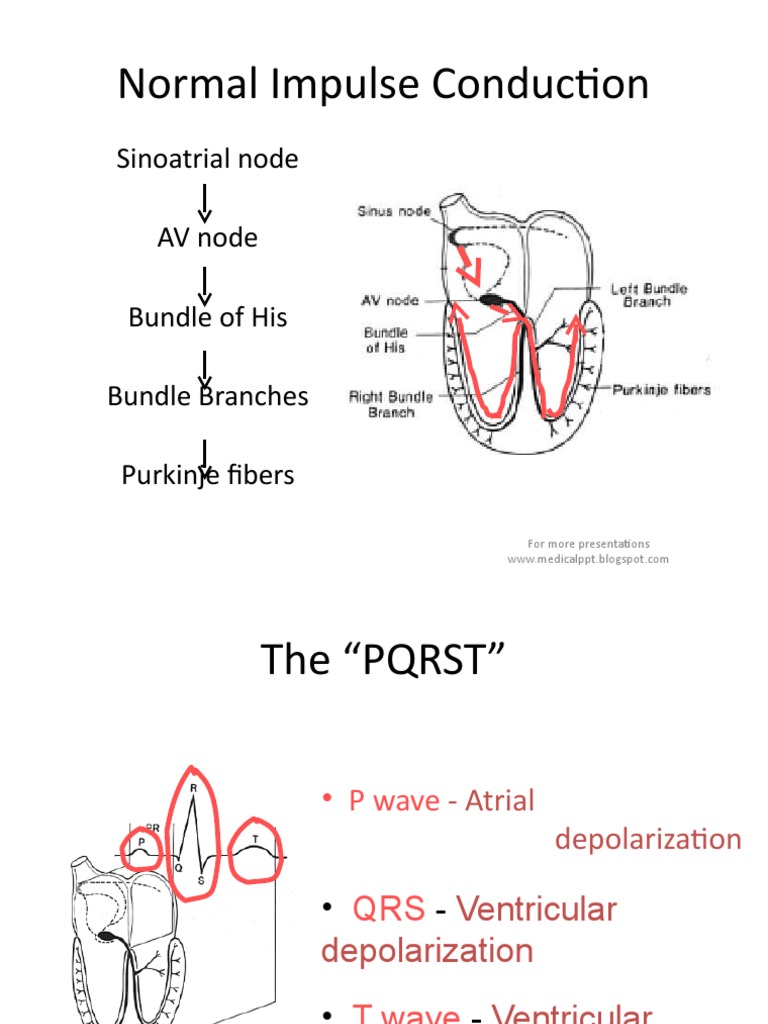 Normal Impulse Conduction: Sinoatrial node AV node Bundle of His Bundle ...