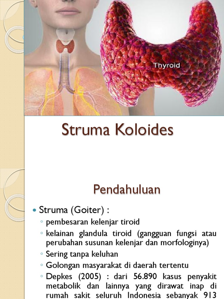 Struma Koloides Slide | PDF
