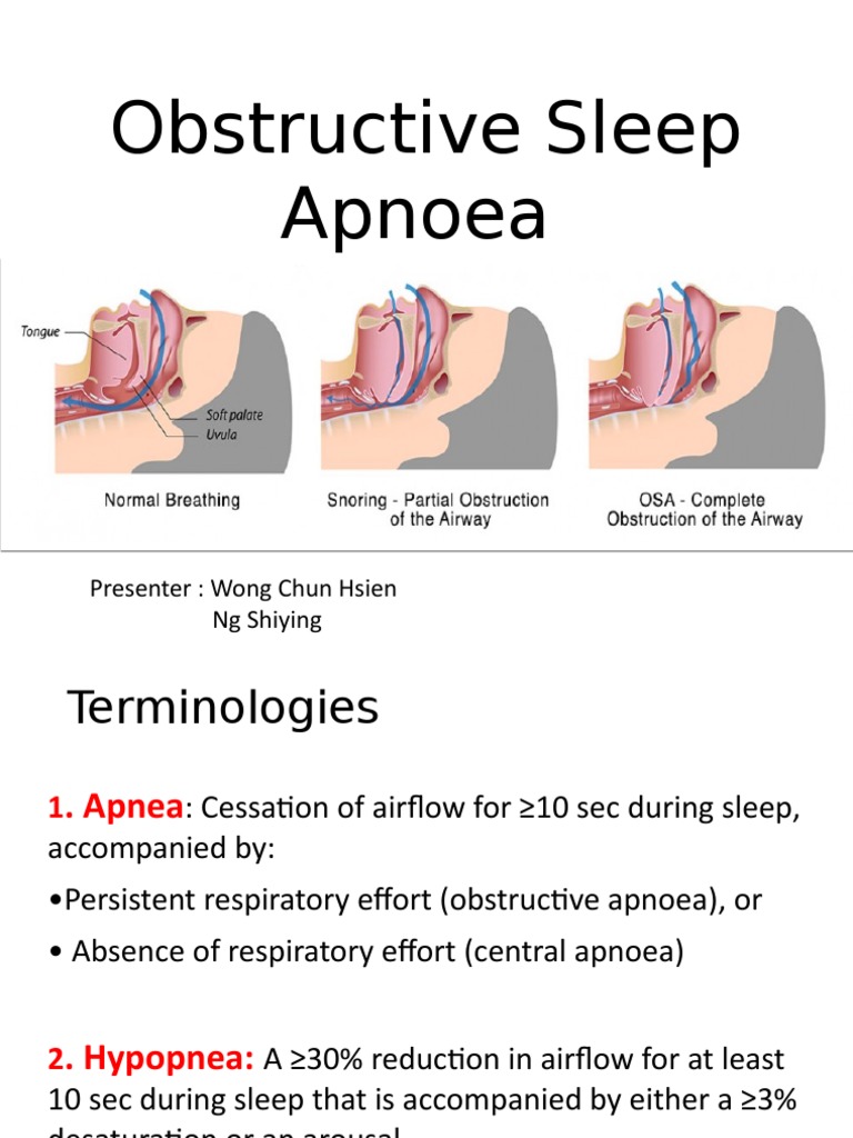 Obstructive Sleep Apnoea | PDF | Sleep Apnea | Apnea