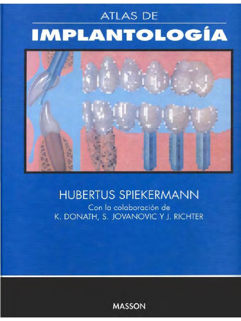 Atlas de Implantología - Spiekermann PDF | PDF Atlas de Implantología - Spiekermann PDF | PDF